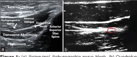 Figure 1 From Ultrasound Guided Quadratus Lumborum Block Versus Ilioinguinal Iliohypogastric
