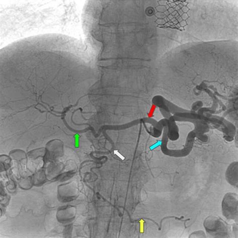 Mesenteric Angiogram Shows The Tortuous Origins Of The Common Hepatic