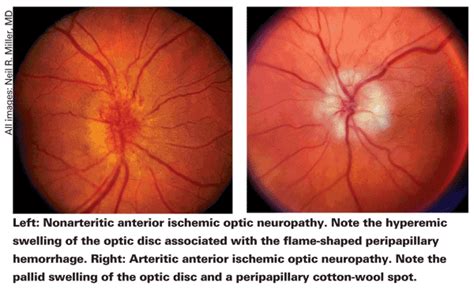 Optic Neuritis Vs Normal