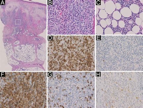 Insect Bite Like Reaction In A Patient With T Cell Lymphoma Anais