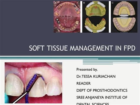 Soft Tissue Management In Fixed Partial Denture Pptx