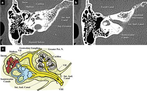 The Temporal Bone Basic Anatomy And Approaches To Internal Auditory