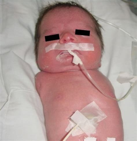 Lecture 2 Lower Limb Embryology Flashcards Quizlet