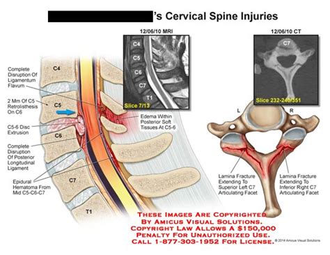 Cervical Spine Injuries