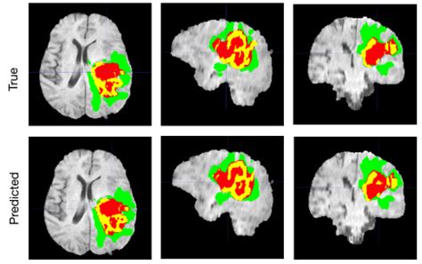 D MRI Brain Tumor Segmentation Using Autoencoder Regularization DeepAI