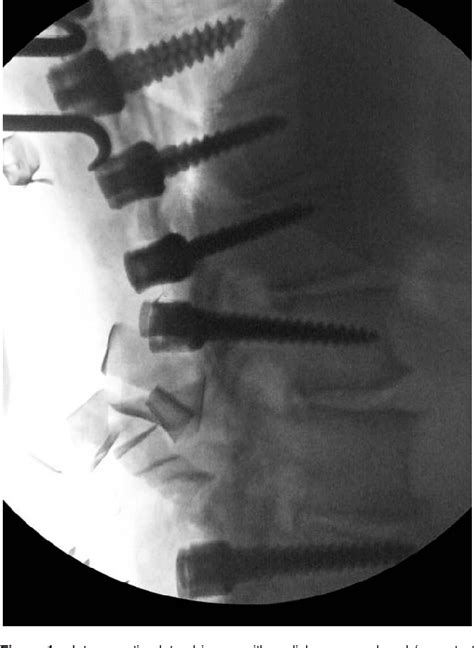 Figure 1 From Osteotomy For Fixed Sagittal Plane Deformities In Adults