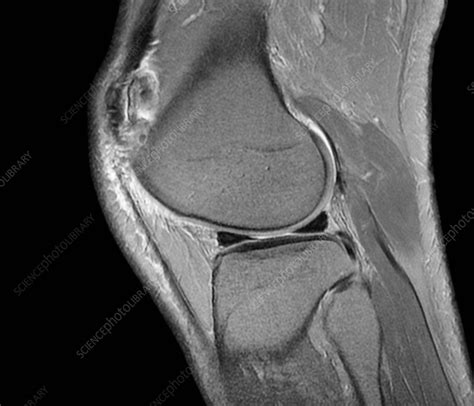 How To Read Knee Mri Of Normal Knee Anatomy Of The Knee Mri Scan Of