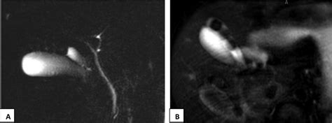A Two Separate Gallbladders B One Gallbladder With Multiple Download Scientific Diagram