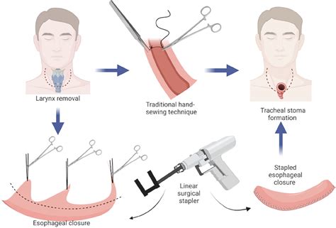 Laryngectomy Procedure Steps