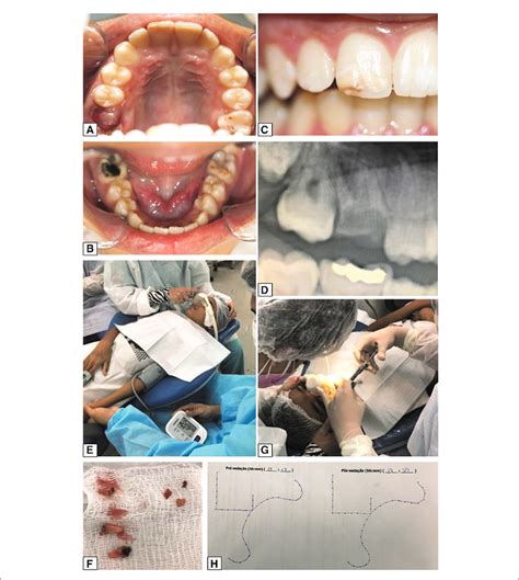 A C Clinical Images Showing Enamel Defect On Teeth 11 26 And 36 Download Scientific Diagram