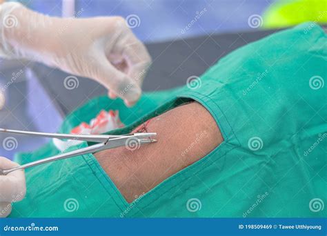 Cut Wound Surgering Stock Image Image Of Surgery Health 198509469