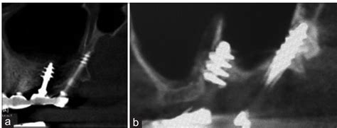 Method 8 A The Implant In The Area Of The 1° Upper Molar
