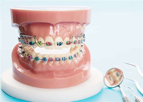 Traditional Braces Melbourne Smile Solutions
