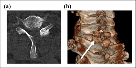A And B The Postoperative Computed Tomography Ct Scan Shows The