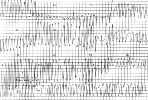 Atrial Fibrillationflutter In Pre Excitation • Litfl • Ecg Library