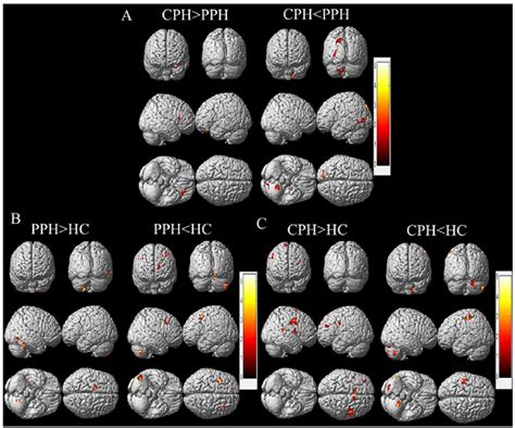 Significant Differences In Functional Connectivity Of Contralesional M1