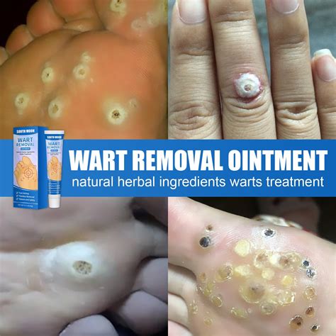 Buy Fast Acting Wart Remover Plantar And Genital Wart Treatment Attacks Warts On Contact