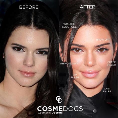 Kendall Jenners Surgeriesfillers Are Goals She Looks Amazing I Can