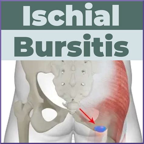 Ischial Bursitis Review Sports Medicine Review