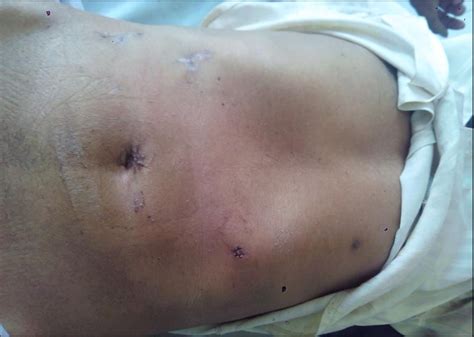 Post Operative Photograph Showing Port Position For Laparoscopic Peptic Download Scientific