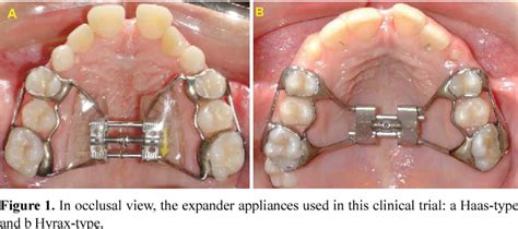 Hyrax Appliance Rapid Maxillary Expansion