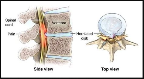 Posterior Cervical Compression Alleviated By Spinal Decompression El