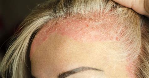 Exfoliative Dermatitis Symptoms Diagnosis And Treatments