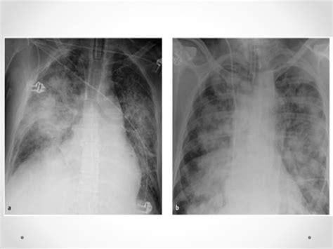 Thoracic Imaging In Icu Ppt