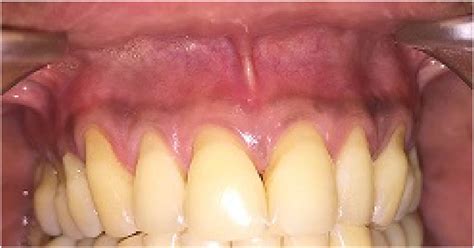 A Baseline Situation Showing Multiple Gingival Recessions In The Maxilla Download Scientific
