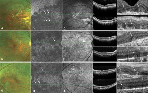 Outer Retinal Tubulation In Bietti Crystalline Dystrophy Associated