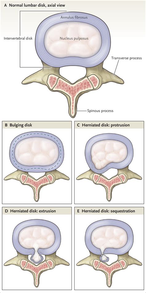 Herniated Lumbar Intervertebral Disk New England Journal Of Medicine