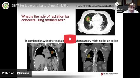 Sbrt For Liver And Lung Mets Dr Miller 2024 Colontown University