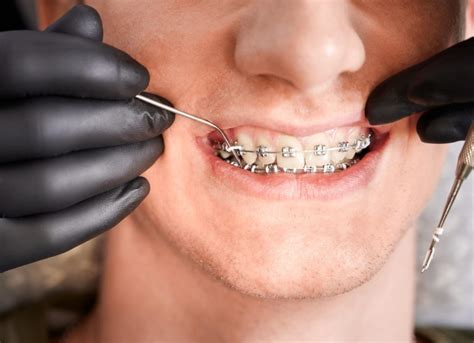 Why Do People Get Braces Somos Dental Phoenix Az