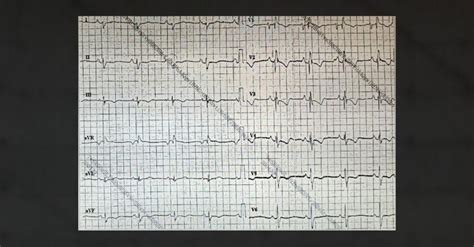 Isolated Right Ventricular Non Compaction In A Young Man Medsynapse