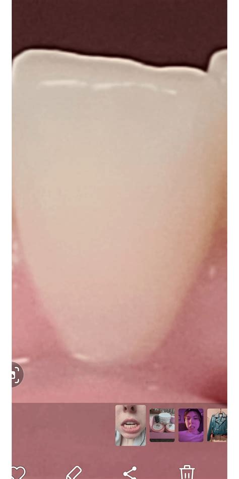 Tiny Chip On Bottom Tooth Raskdentists