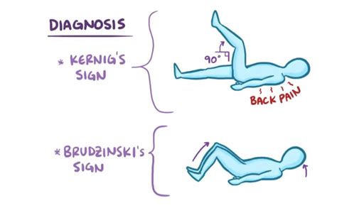 Kernigs Sign Meningitis Tests Brudzinskis And Kernigs Signs