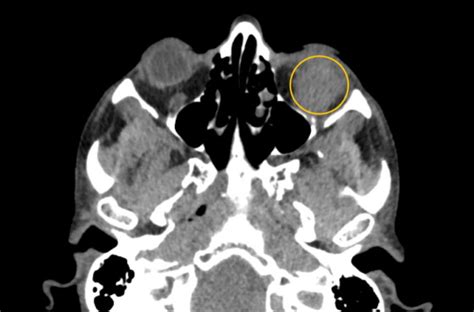Inferior Rectus Abscess Ct Axial Annotated Jetem 2025 Jetem