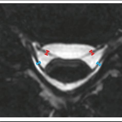 Example Of Intra Spinal Nerve Root Measurements Method Of Measurements Download Scientific