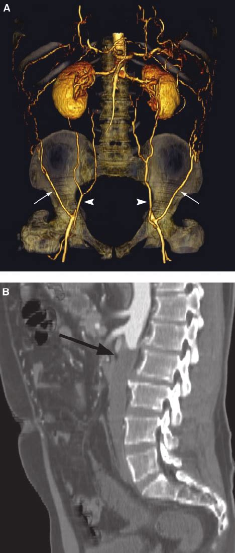 A Preoperative Multislice Spiral Ct Angiography With 3d Volume