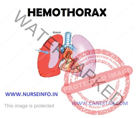 What Is A Hemothorax And What Causes It At Sarah Sepe Blog