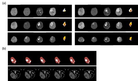 Clinical Dataset For Training Segmentation Model A Brats Is A Download Scientific Diagram