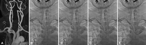 Anatomical Predictors Of Difficult Left Internal Carotid Artery