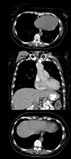 Ct Imaging Of Cardiac Angiosarcoma Subsequent To Propranolol Treatment