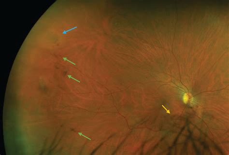 What Is Vitreous Opacity At Mary Cardona Blog