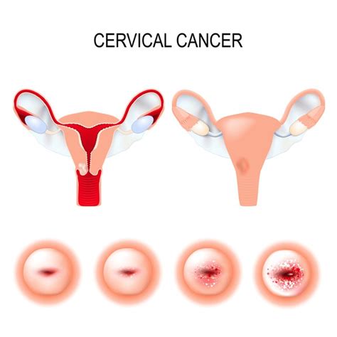 10 Cancer In The Womb And Stages 图片、库存照片、3d 物体和矢量图 Shutterstock