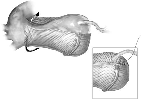 Pears Procedure At Buddy Byram Blog