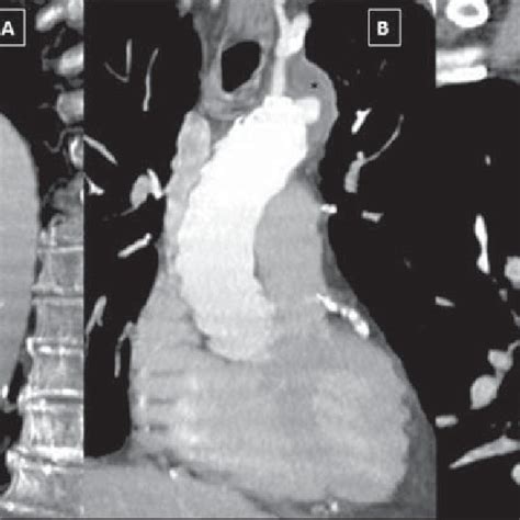 Pdf Hybrid Treatment Of Penetrating Aortic Ulcer