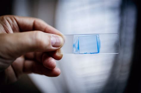 La Misteriosa Infección Que Se Esparce Por El Mundo Debido A La