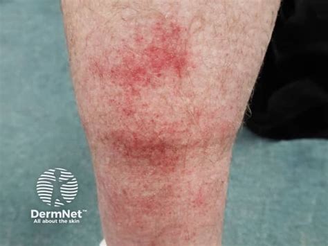 Cellulitis Mimics