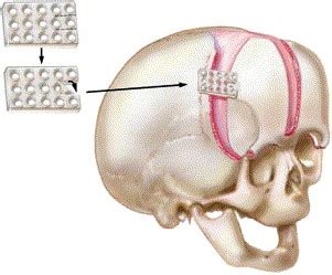 Fronto Orbital And Cranial Osteotomies With Resorbable Fixation Using